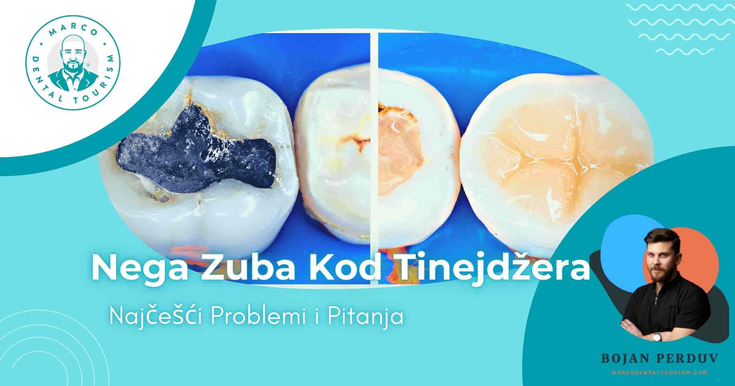 Plombiranje zuba | Kada je potrebna zubna plomba? | MDT