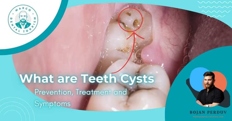 What are Cysts on the Teeth: Prevention, Treatment and Symptoms