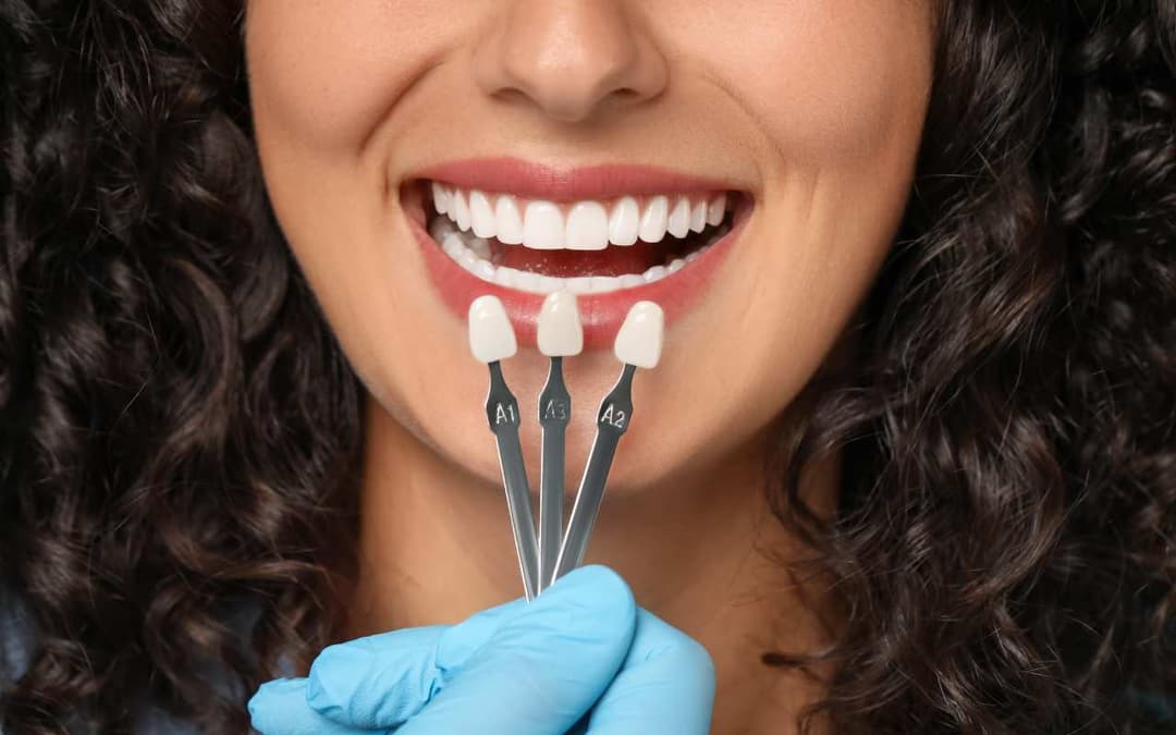 Kompozitne fasete - iskustva, vrste i cene | Marco Dental