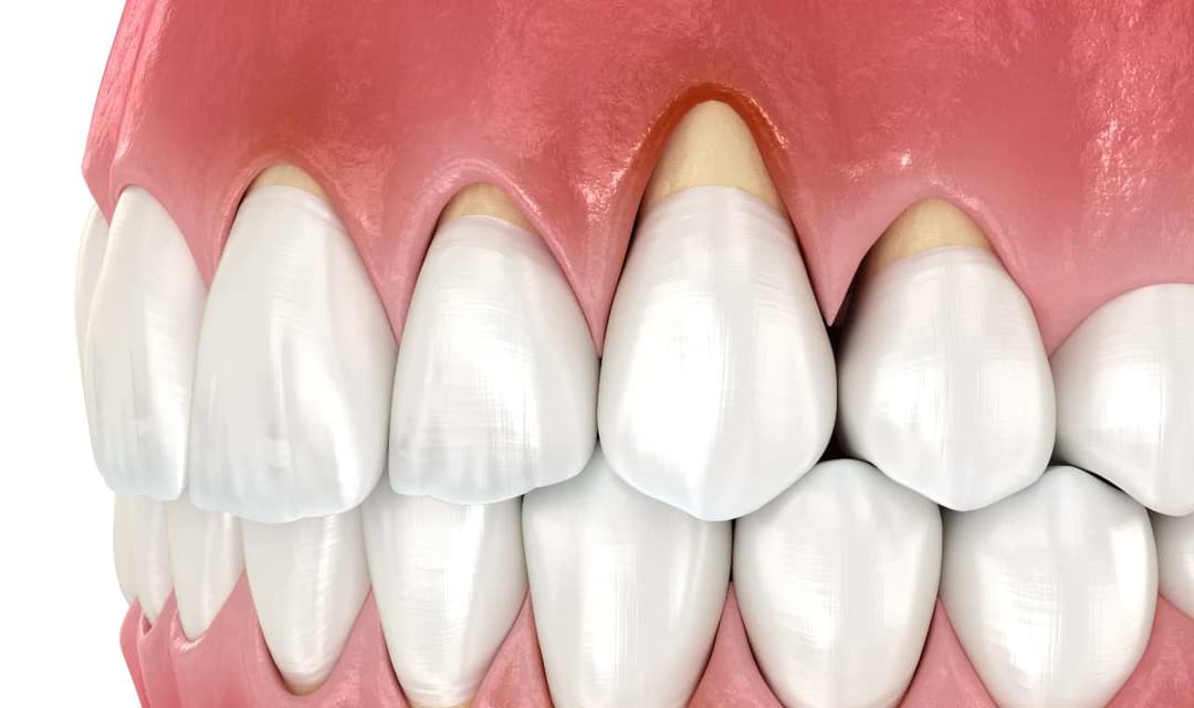 Paradentoza zuba - uzroci, simptomi i lečenje | Marco Dental